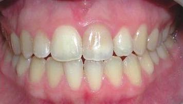 Hva er din mening om bleking av tenner? - TkØ - Tannhelsetjenestens ...